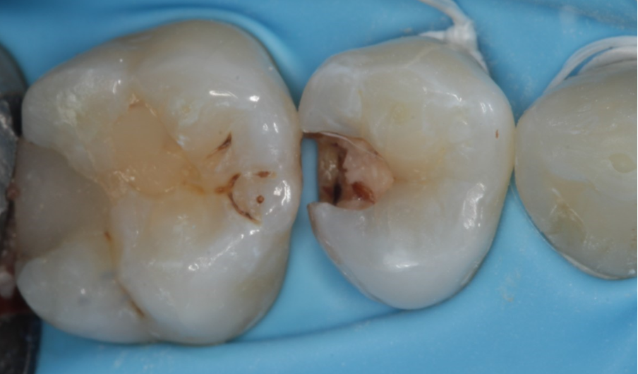 What are cavity fillings and when should you consider them? - Montagu ...