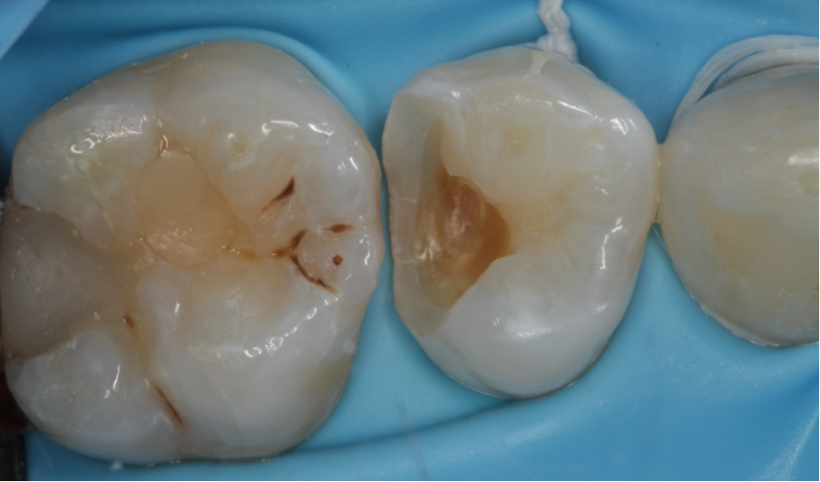 What are cavity fillings and when should you consider them? - Montagu ...
