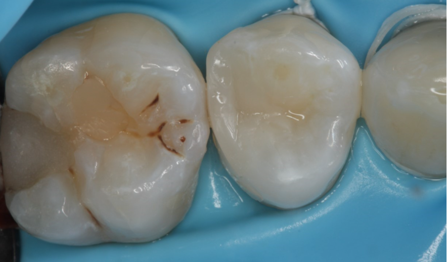 What are cavity fillings and when should you consider them? - Montagu ...